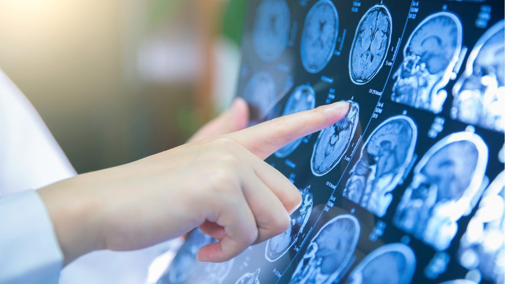 Brain Donation - PSPA