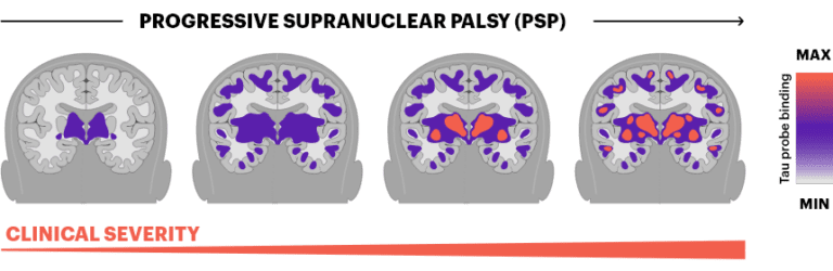 PSP Progressive Supranuclear Palsy | Definitions, Symptoms, Help